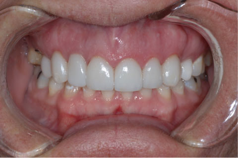 Dental Implants Naples| Implant Dentistry